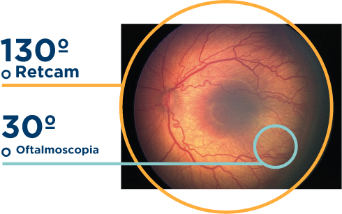 Retcam Envision - Advance Vision